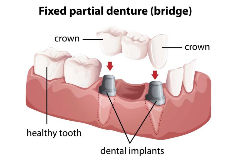 Calgary Dental Bridges - Dental Bridge Replacement | Pathways Dental Clinic